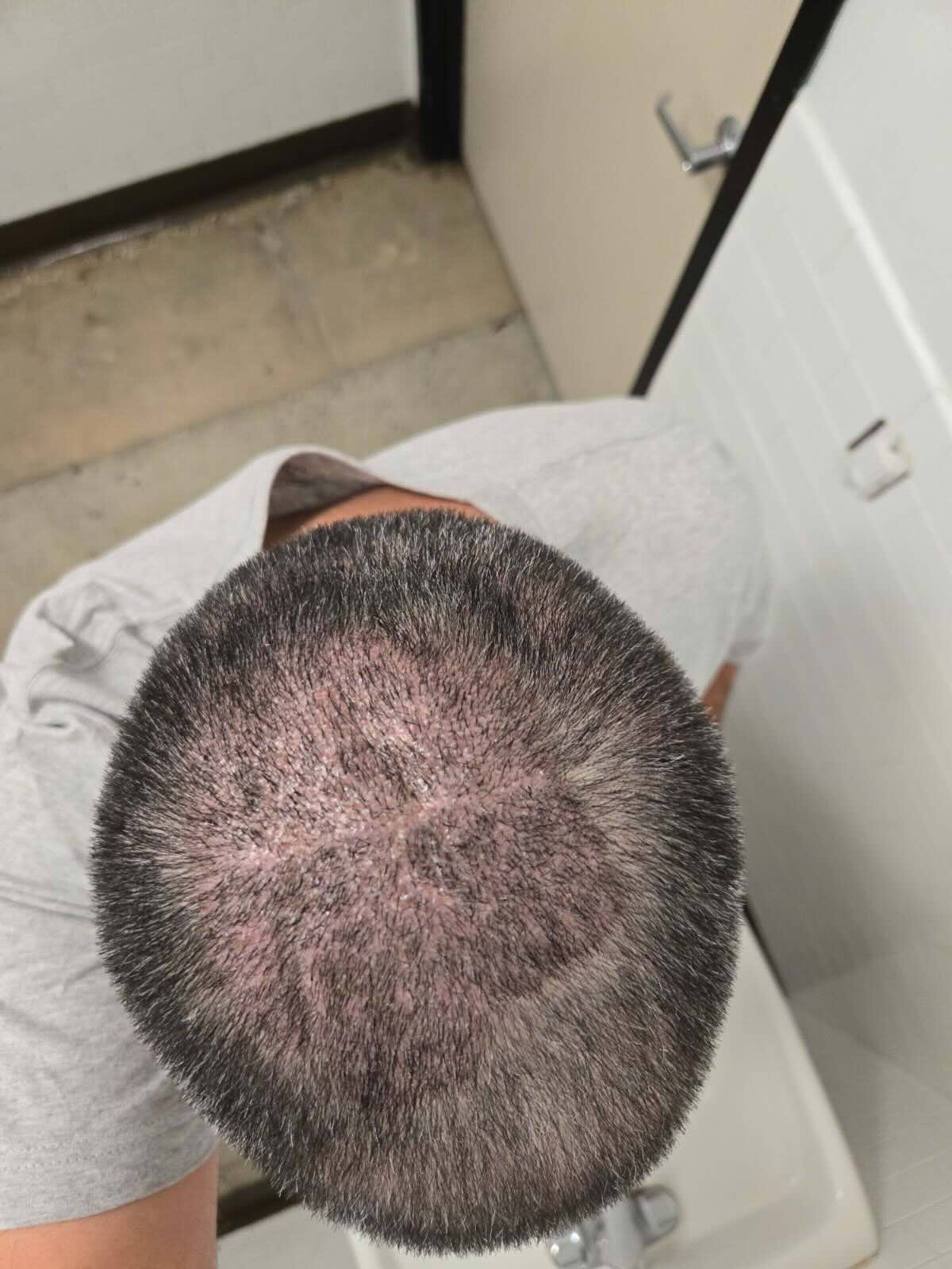 2588-Graft Crown Hair Transplant Recovery | Beverly Hills Case