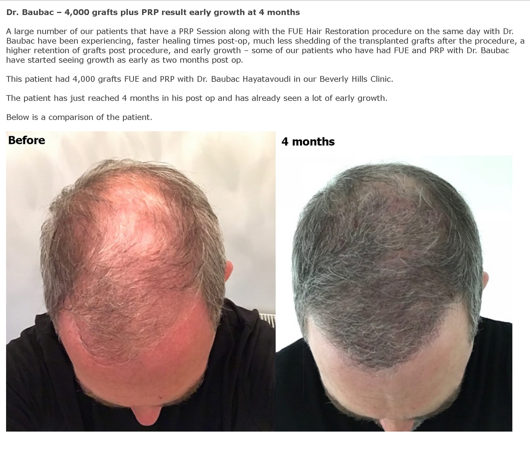 Dr Baubacs Patients Are Seeing Faster Results With Prp In Combination