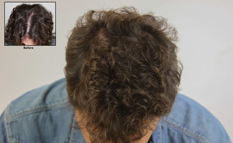 diffuse hair loss Archives - Alvi Armani International