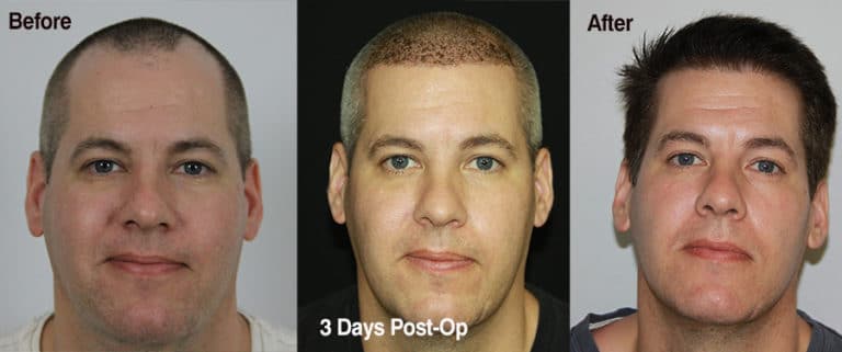 Temple Recession Hair Transplant - Alvi Armani International