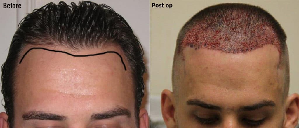 Hairline Lowering Fue Hair Restoration Result Alvi Armani Hair