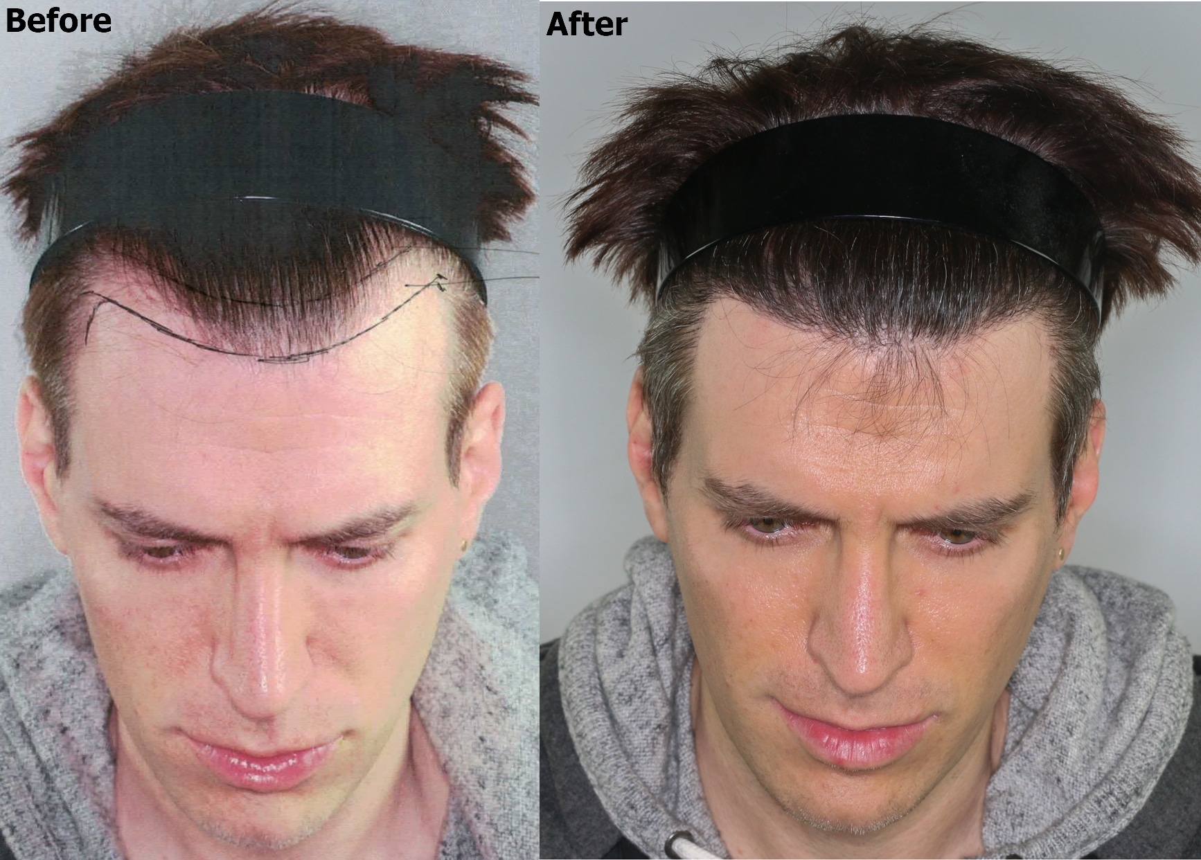 Temple Recession Restored With Fue Prp Alvi Armani Hair