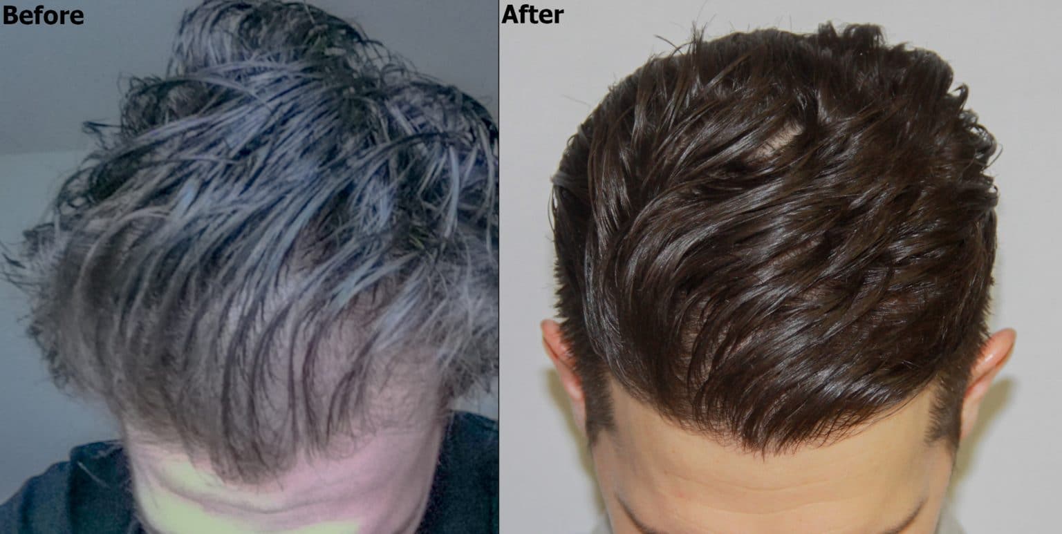 Diffuse Frontal Thinning FUE Hair Restoration - Alvi Armani International