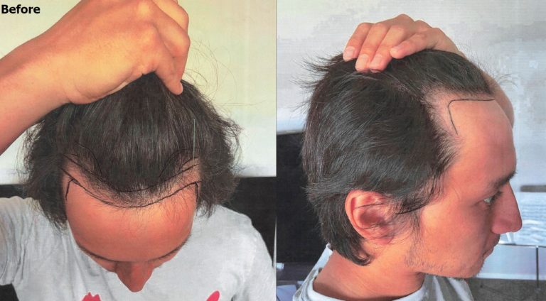 Fall Guy Hair Restoration - AlviArmani International